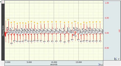 How Can I Move Qrs Peak Event Marks From The Bottom Of S Waves To The