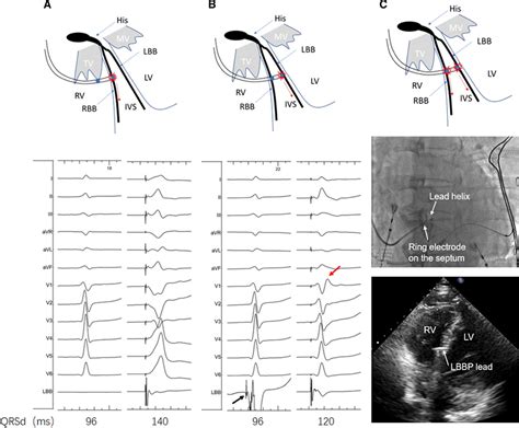 Bilateral Bundle Branch Area Pacing To Achieve Physiological Conduction System Activation