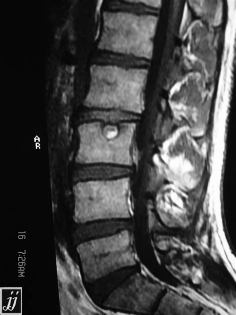 Deep Schmorls Node Radiopaedia