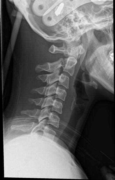 Normal Cervical X Ray