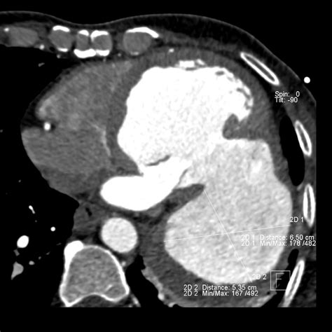 Cta Showing The Dimensions Of The Aneurysms In Axial Plane Download