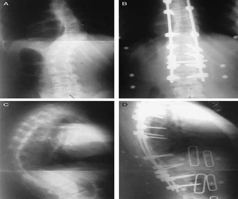 The Effect Of Concomitant Rib Deformity In Congenital Scolio
