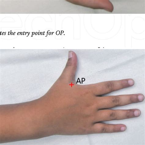 Adductor Pollicis Ap Plus Denotes The Injection Point Download Scientific Diagram