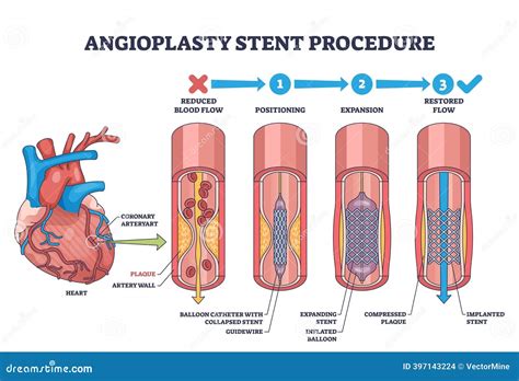 Angioplasty Diagram For Peripheral Artery Disease Stock Image