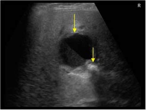 Abdomen And Retroperitoneum 12 Gallbladder And Bile Ducts Case 128 Gallbladder Abscess