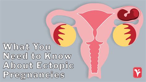 Ruptured Ectopic Pregnancy Signs Symptoms Treatment 56 Off