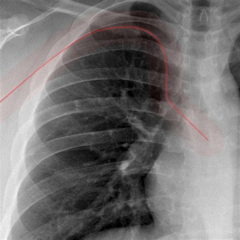 Picc Line Xray