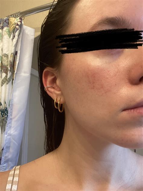 Are These Broken Capillariesblood Vessels Rrosacea