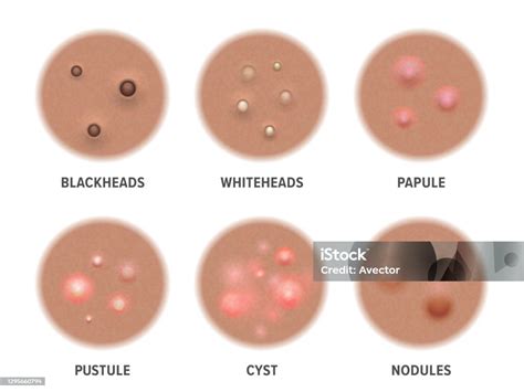 어두운 피부 얼굴 여드름 과 혜성 벡터 블랙 헤드와 모공 낭종에 여드름 유형 피부 여드름 유형 미용 및 스킨 케어 트리트먼트 0명에 대한 스톡 벡터 아트 및 기타 이미지
