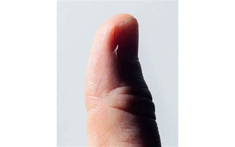 Qu Hacer Cuando Te Sale Un Padrastro