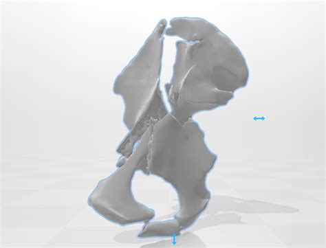 Pelvic Fracture By Austin Quinn Download Free STL Model Printables Com