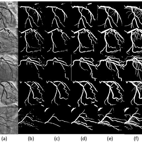 examples of different vessel segmentation methods a original images