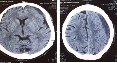 Subacute Subdural Haematoma Can Be Difficult To Identify On Porn Sex
