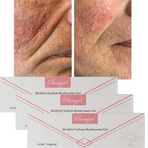 Plastic Surgery Implants Face Filling Injection Price Injectable