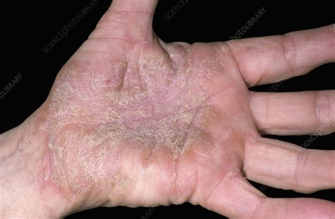 Palmar Keratoderma On The Hand Stock Image C049 4400 Science Photo Library