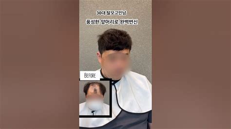 탈모 고민 남 두피페인팅 증모술로 풍성한 머리로 변신 블랭크유 증모술 탈모붙임머리 두피염색 남자머리 블랭크유하랑 Youtube