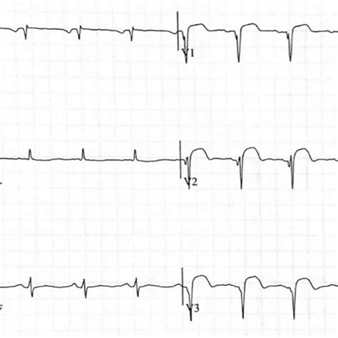 Ecg St Segment Elevation In Anterior Leads With Loss Of The First Vector Download Scientific