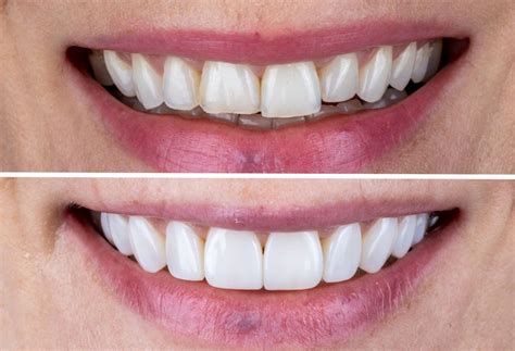 Monoshade Composite Bonding