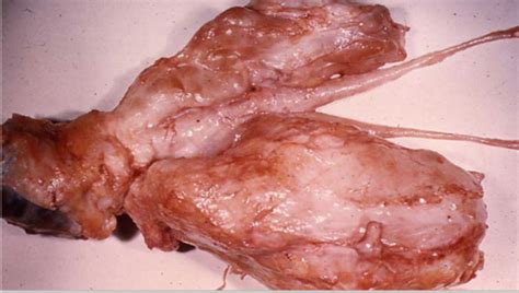 Andrology I Non Neoplastic Disease Of Accessory Sex Glands Dr P Flashcards Quizlet