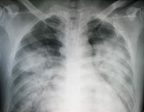 Ards Chest X Ray
