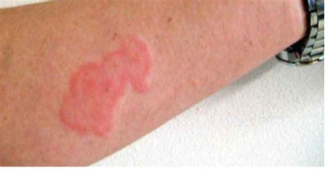 피 빨아먹는 베드 버그 여기서도 전국 때 아닌 곤욕 박멸 방법은