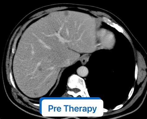 Sinusoidal Obstruction Syndrome Sos Chemoradiotherapy Can Impact The Rajesh Sasidharan
