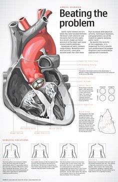 Best Aortic Stenosis Ideas Aortic Stenosis Stenosis Cardiac Nursing