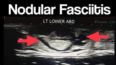 Nodular Fasciitis Youtube