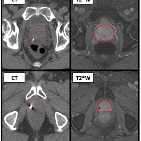 Clinical Example Of The Variation In Signal Loss Top Line‐ct Left