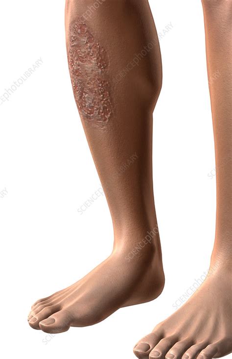 Pyoderma Gangrenosum Stock Image F002 0237 Science Photo Library