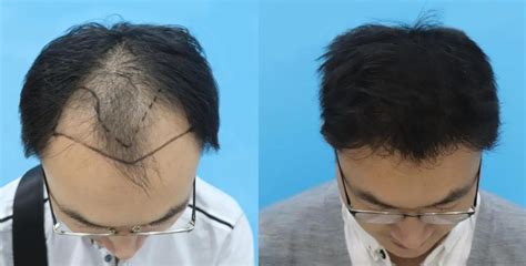 江苏植发比较好的医院有哪些南京碧莲盛苏州百年因技术好排名前十 知乎