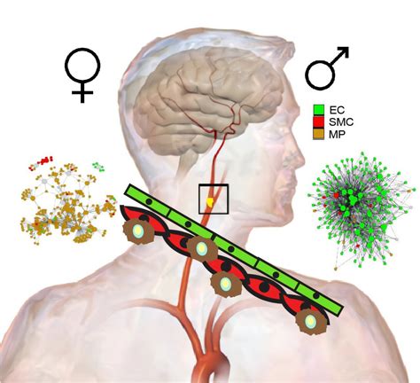 Sex Differences In Carotid Artery Plaques And Stroke Symptoms Revealed In New Study Sex Differences In Carotid Artery Plaques And Stroke Symptoms Revealed In New Study