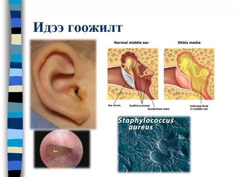Дунд чихний архаг үрэвсэл Pptx