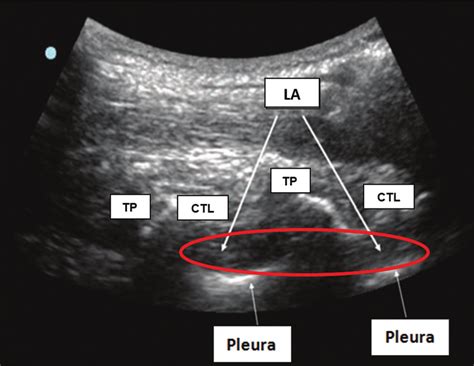 Ultrasound Scan Of The Thoracic Paravertebral Space At T4 Level Using Download Scientific
