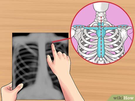 How To Read A Chest X Ray With Pictures WikiHow