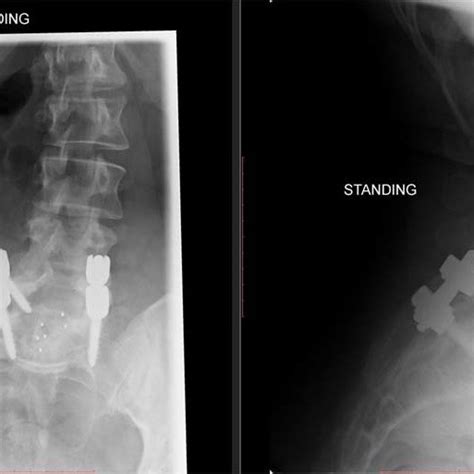 Postoperative Mri Of The Lumbar Spine Performed In January 2017 Download Scientific Diagram