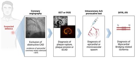 Myocardial Bridge
