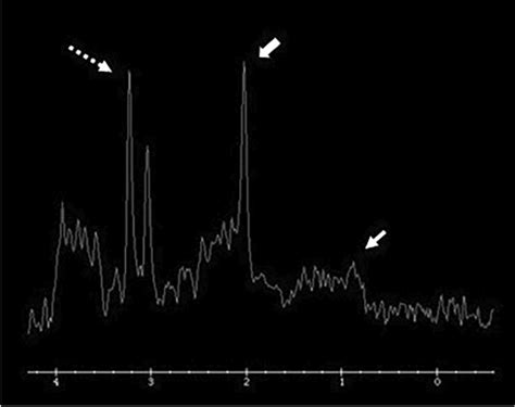 Single Voxel Spectroscopy With Voxel Localized In Centrum Semiovale