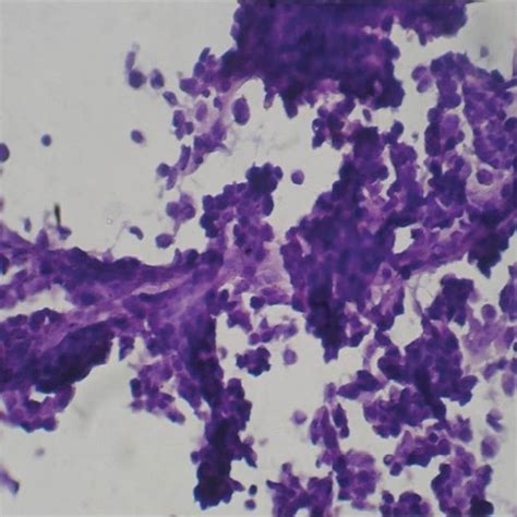 Smear Shows Alveolar Structures Composed Of Roundish Cells Around A Download Scientific Diagram