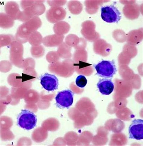 Peds Exam 4 Oncology Flashcards Quizlet