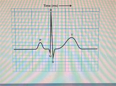 Solved In The QRS Complex Shown Here The PR Interval Is The QRS Interval Course Hero