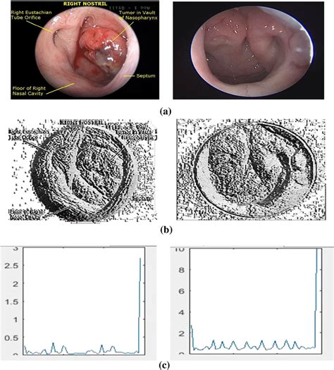 A Benign Tumor Formed By An Abnormal Collection
