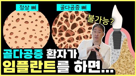 골다공증 약 중단 후 임플란트 골다공증 환자 임플란트 시 주의사항 꼭 알고 하셔야 됩니다 Youtube