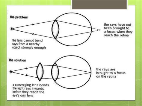 Refraction In Different Refractive Errors And Their Management