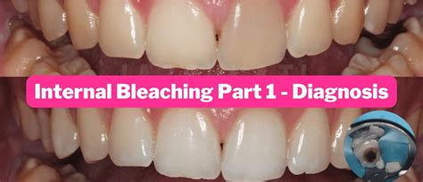 Internal Whitening Protocols Pt1 Non Vital Bleaching Pdp146 Protrusive Dental Podcast