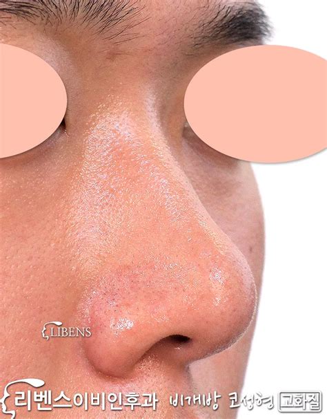 비개방 코성형 매우 큰 넓은 복코 수술 코끝 성형 콧볼축소 전후사진 S1242