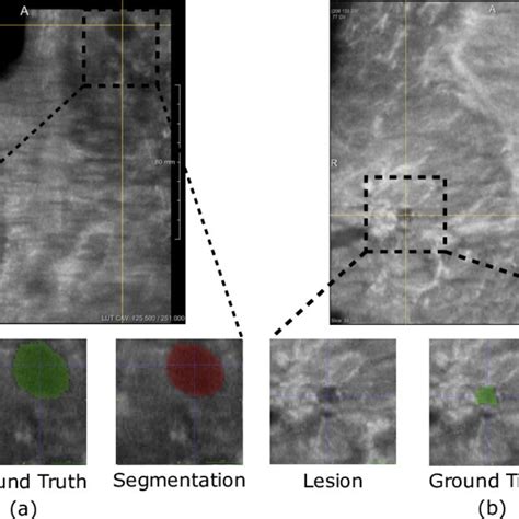 Pdf Lesion Segmentation In Automated 3d Breast Ultrasound Volumetric Analysis