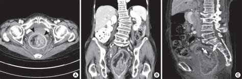 Ct Shows An Intussusception Mainly From The Proximal Sigmoid Colon Download Scientific Diagram
