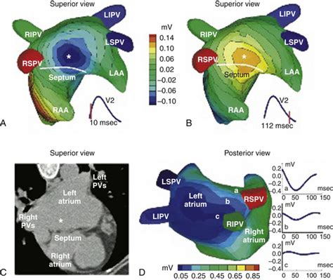 Focal Atrial Tachycardia Musculoskeletal Key