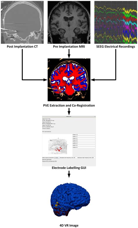 Overview Of The Software Pipeline Outlining Input Of Ct Mri And Seeg